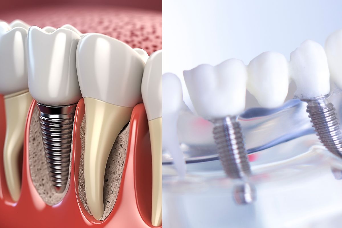 Choosing Between Single and Multiple Dental Implants